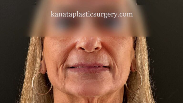 Croton Peel - Kanata Plastic and Cosmetic Surgery