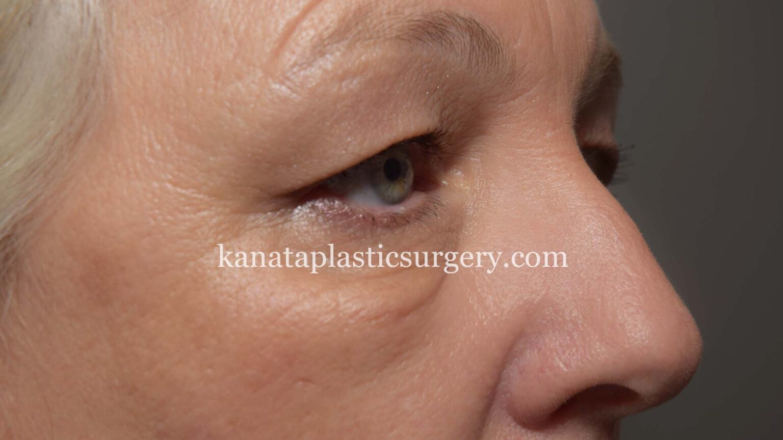 Eyelid Surgery in Ottawa | Kanata Plastic & Cosmetic Surgery